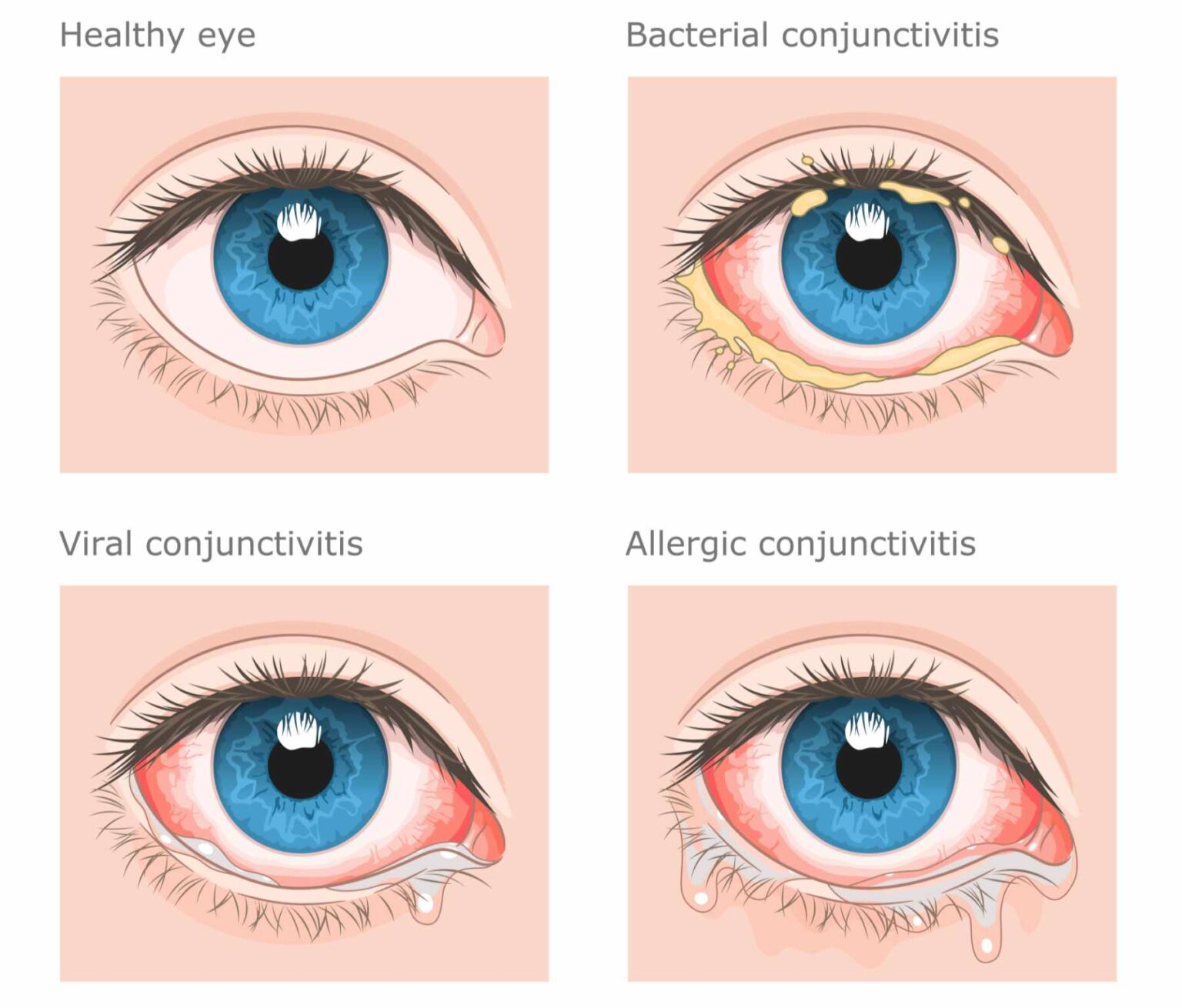 Pink Eye Infection Treatment | Quick Online Help | Chatrx