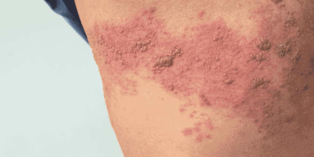 Shingles Contagious Transmission: What You Should Know